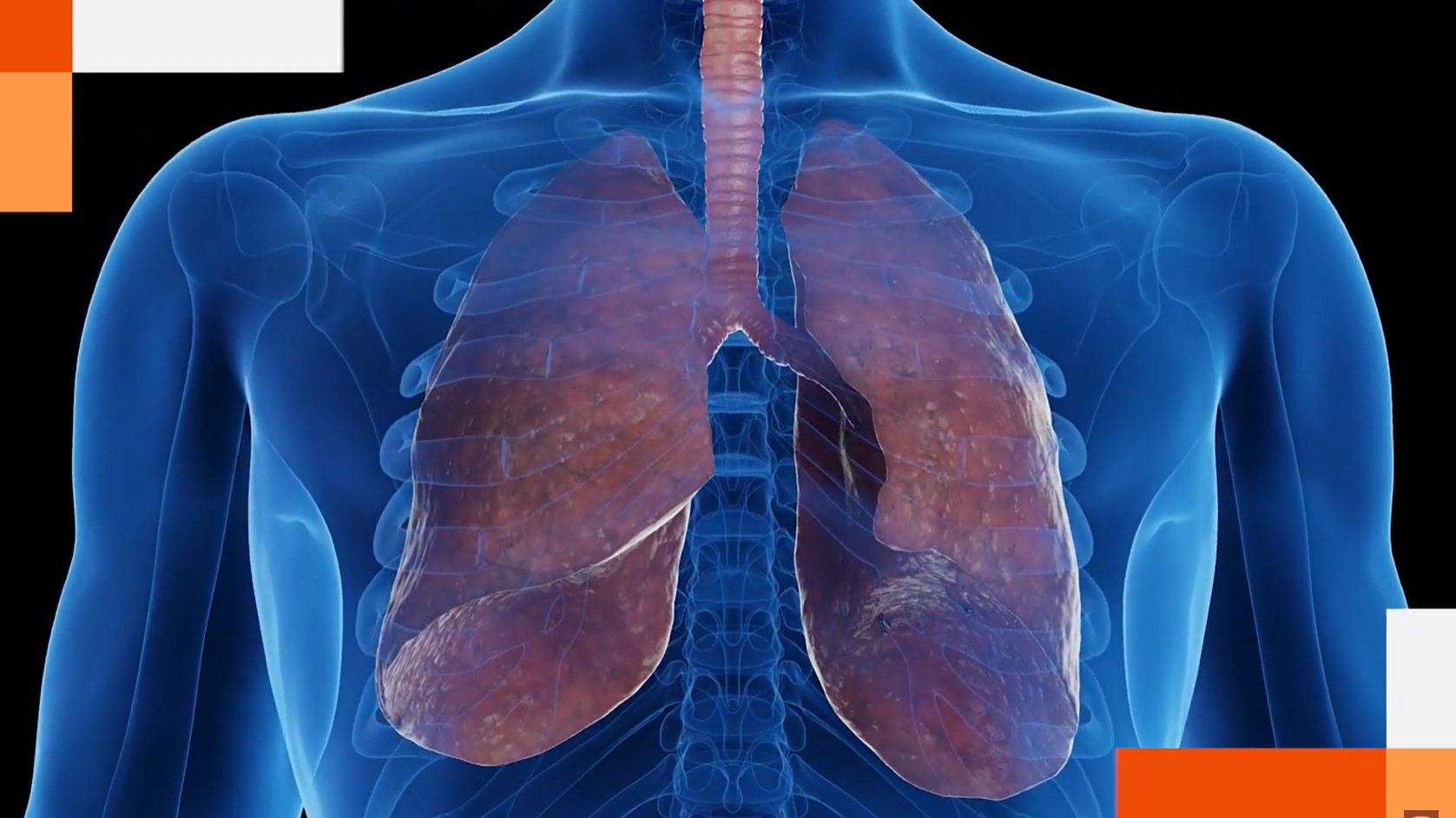 Pulmones en alerta: Lo que no sabías sobre la fibrosis pulmonar ...